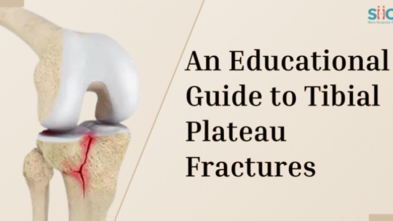 An Educational Guide to Tibial Plateau Fractures | WONGCW Official Site